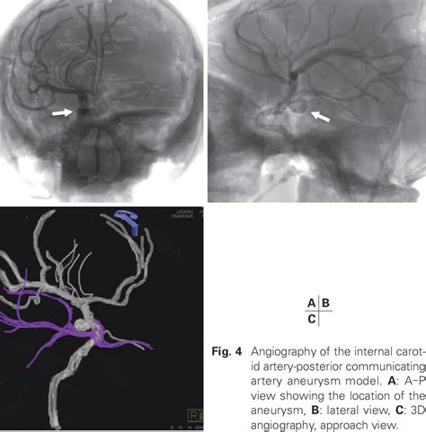 Figure 4 From A Cerebral Aneurysm Model For Clipping Training