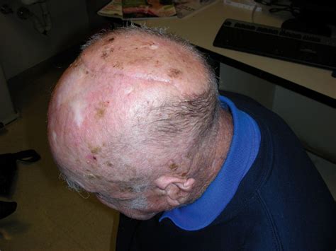 Scalp Reconstruction Plastic Surgery Key