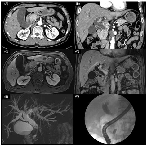 Diagnosis Of Cholangiocarcinoma PMC