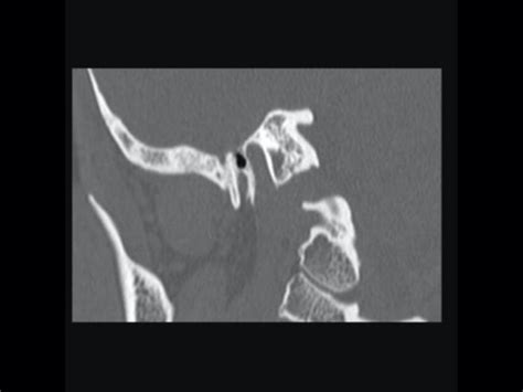 Normal Temporal Bone Ct With Annotated Images Radiopaedia 84293 99584 Poschl Annotated Nc