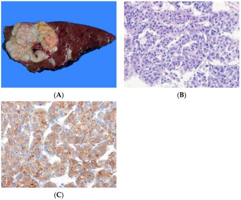 Combined Hepatocellular Cholangiocarcinoma An Update On Pathology And