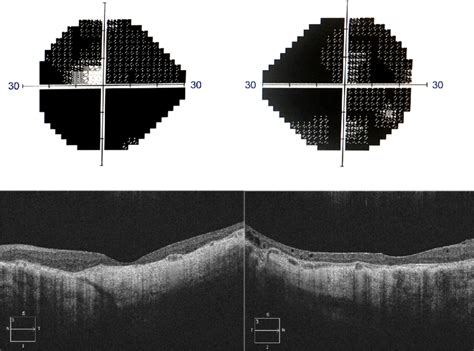 Humphrey Visual Field Testing Shows Marked Constriction Of The Download Scientific Diagram