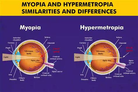 Difference Between Myopia And Hypermetropia Complete Guide