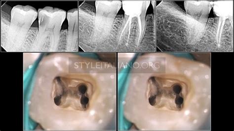 The Radix Entomolaris Style Italiano Endodontics