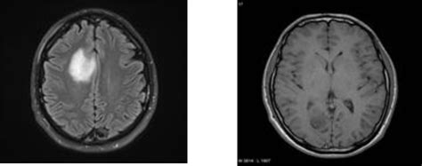 Figure 2 From The Automatic Brain Tumor Segmentation Based On Mri Using