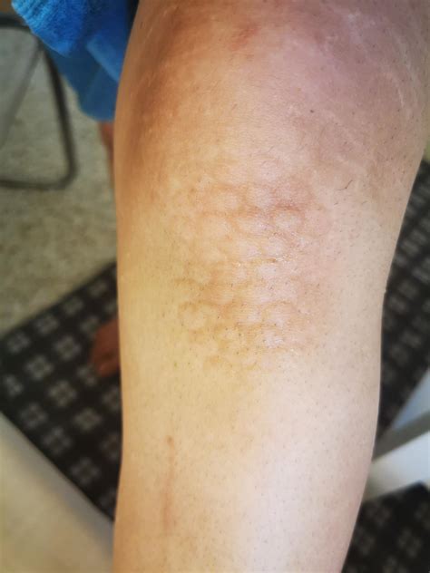 Weird Symmetrical Hard Bumps On Knees Medical