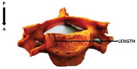 Uncinate Process Vertebra