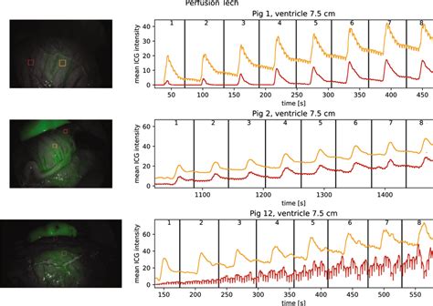 Baseline Perfusion Measurement Of The Ventricle After Priming Dose