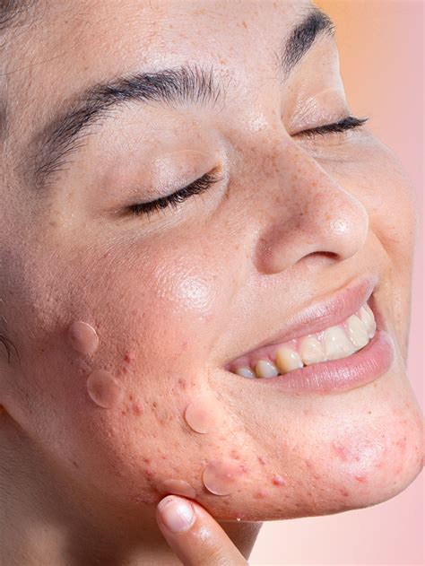 What Do You Do If A Pimple Starts Bleeding Hanhoousa