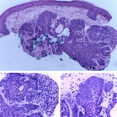 At Lower A And Higher B And C Magnifications Basaloid Cells Download Scientific Diagram