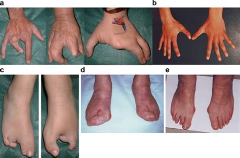 Clinical Genetic And Molecular Aspects Of Split‐hand Foot