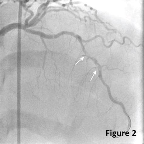 Stemi From Plaque Erosion Cardiology Apps