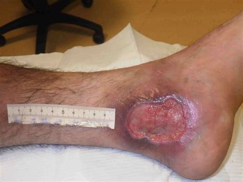 Pyoderma Gangränosum Übersicht Zum Krankheitsbild