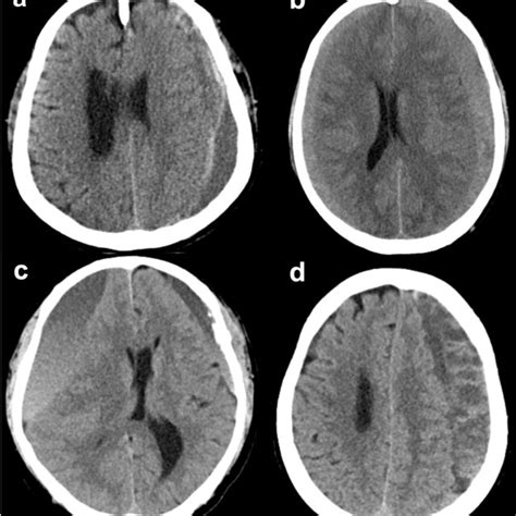 Axial Cut Computed Tomography Image Showing Hematoma Types According To