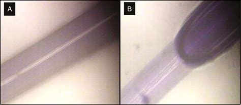 In Vitro Degradation Of Polydioxanone Lifting Threads In Hyaluronic