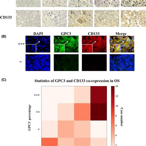 Immunohistochemical Profiling Of Intertumoral And Intratumoral Gpc3 Download Scientific Diagram