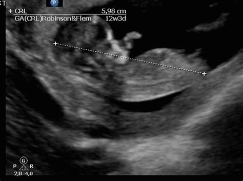 Turtle Sign Ultrasound