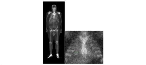 Example Of Scintigraphy With PYP Tc M To Investigate Cardiac Download Scientific Diagram