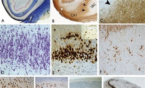 Mesial Temporal Sclerosis Neuropedia
