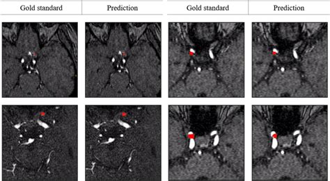 Example Results Of Aneurysm Segmentation In Internal Test Datasets