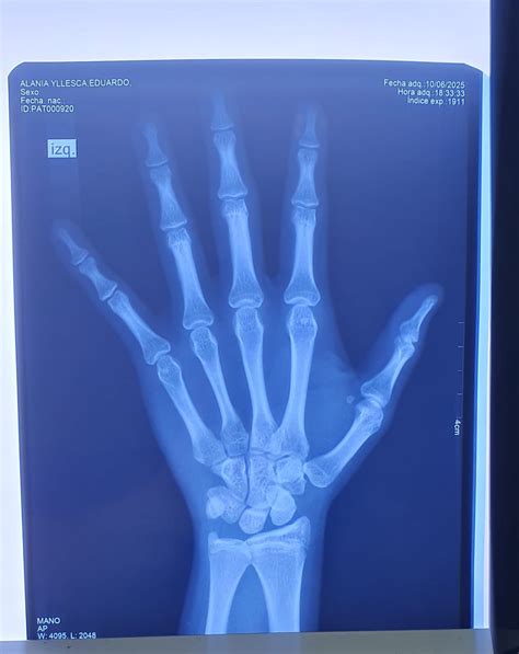 Radiografia Mano Album On Imgur