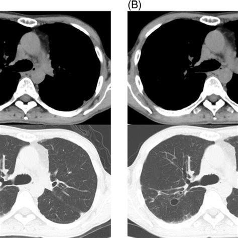 Chest Computed Tomography Ct Shows A Lung Nodule And A Calcified Download Scientific Diagram