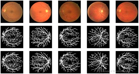 Github Julio M3910 Segmentationofretinavessels