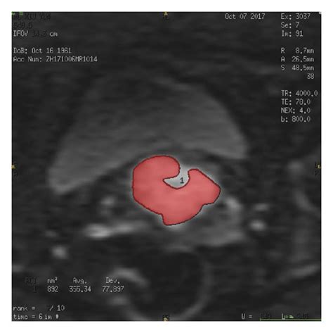Example Of Manually Drawing Roi For Cscc Ki 67 Pi 60 For Ivim Dwi