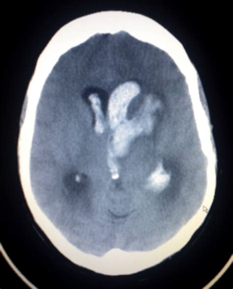 Hemorragia Intracerebral Concise Medical Knowledge