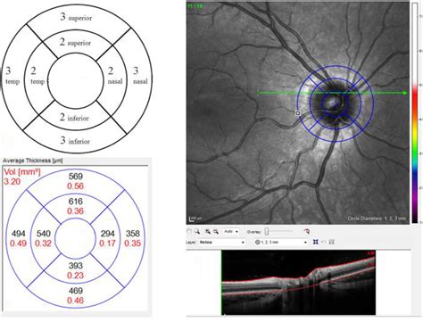 Volume Scan The Volume Scan Provides Both Retinal Thickness And