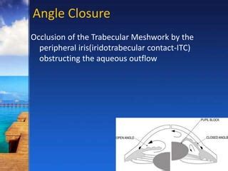 Primary Angle Closure Glaucomadr Ferdous Pptx
