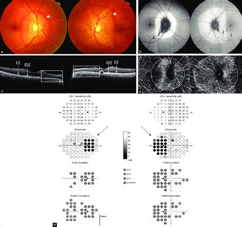 A Color Fundus Photograph Ou Showing Orange Yellow Colored Download Scientific Diagram