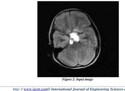 Pdf An Efficient Brain Tumor Detection Usingmodified K Means