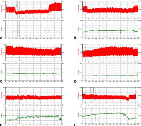 Table 2 From Interpretation Of Autonomic Function Test Semantic Scholar