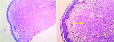 A Normal Epidermis Well Circumscribed Partially Encapsulated Nodule
