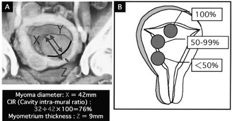 A The Analytical Method For Determining The Cavity Intramural Ratio