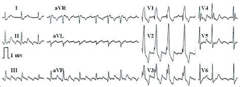 Variable Atrioventricular Conduction In A Typical Atrial Flutter The