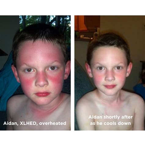 National Foundation For Ectodermal Dysplasias On Linkedin Ectodermaldysplasia Xlhed Edelife