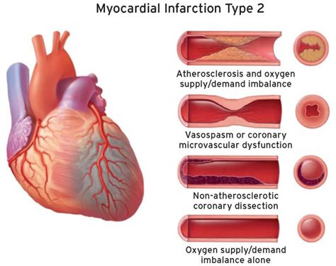 Myocardial Infarction Definition Causes Signs Symptoms Diagnosis And Treatment