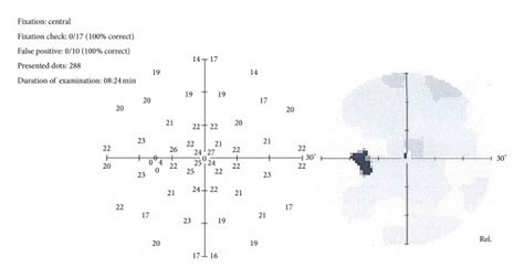A Arcuate Defects In The Right Eyes Visual Field Examination B