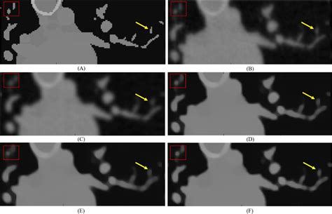 Figure 10 From Low Dose Cone Beam Ct Iterative Reconstruction Via Total Variation And Gradient