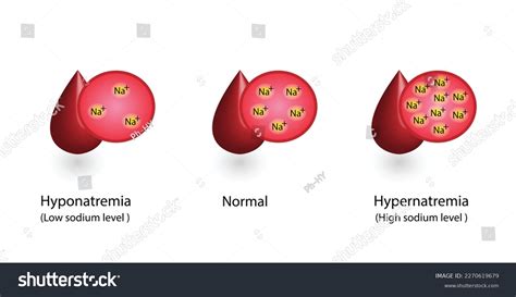 Hypernatremia High Plasma Sodium Level Hyponatremia Stock Vector Royalty Free 2270619679