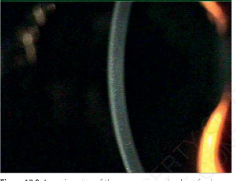 Corneal Parallelepiped