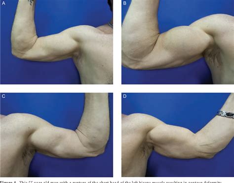 Bicep Implants