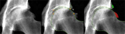 Osteophyte Size And Location On Hip Dxa Scans Are Associated With Hip