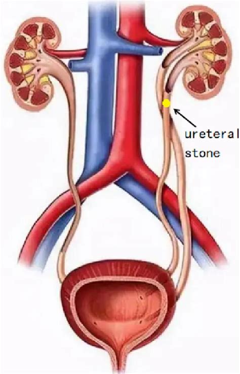 Unrecognized Complete Ureteral Duplication With The Calculus In The