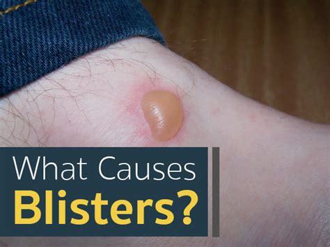 Blisters Causes Fluid Inside And Treatment Fyzql