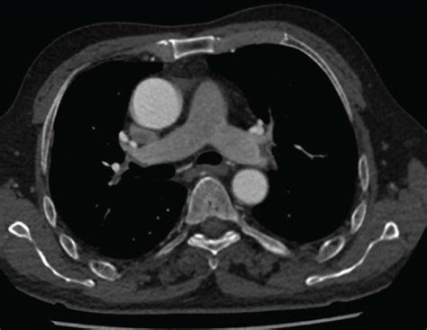 Computed Tomography Angiography Cta Showed Pulmonary Embolism Download Scientific Diagram