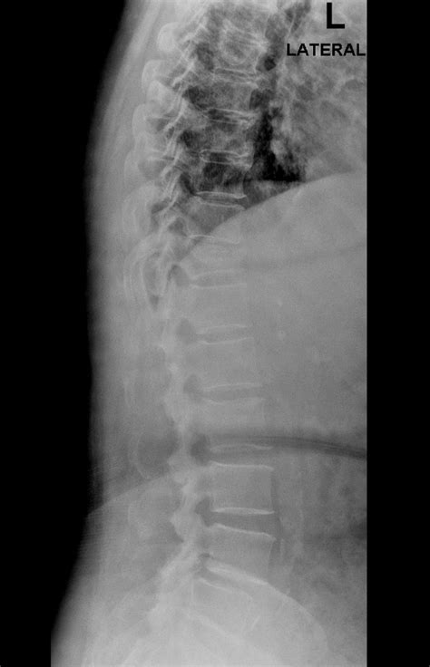 Compression Fracture Of T11 Uni Clinic