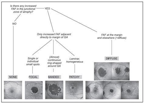 Fundus Autofluorescence Patterns And Optical Coherence Tomography In Geographic Atrophy